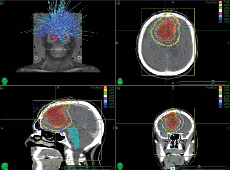 Cyberknife Robotic Radiosurgery - Technology, Cancer Treatment